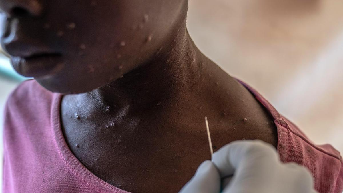 Mpox mutant clade Ib strain changing faster than expected as scientists ...